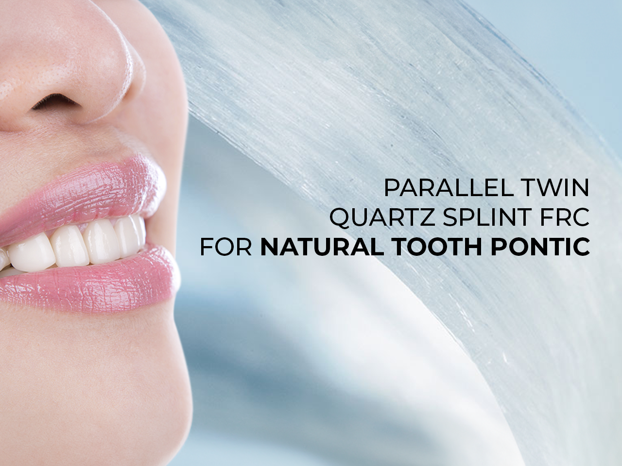 PARALLEL TWIN QUARTZ SPLINT FRC FOR NATURAL TOOTH PONTIC - Dental ...