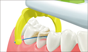 デンタルフロスは必要：Dental floss/flosser デンタルフロス/フロッサー