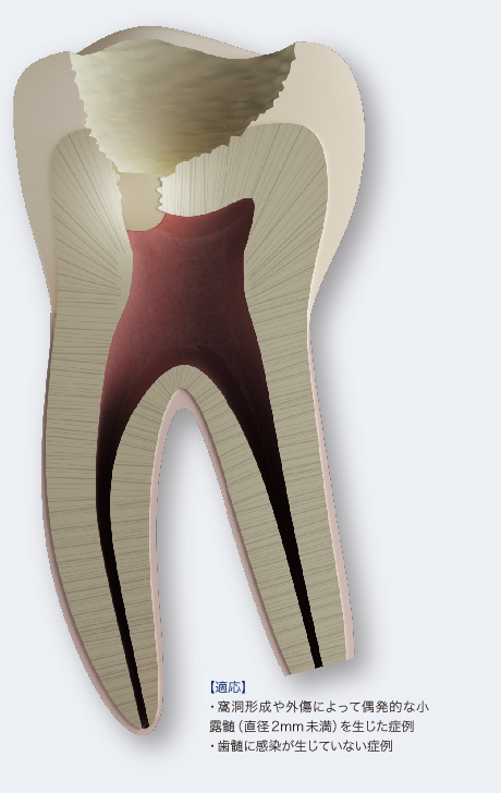 MTAセメント － NEXシリーズ