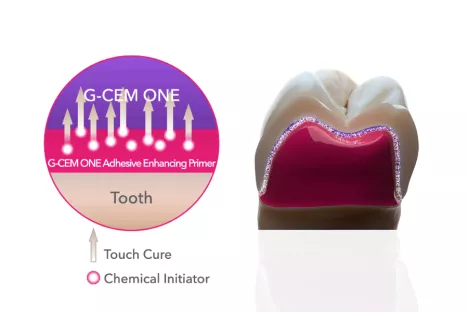 From Challenges to Confidence: How G-CEM ONE Revolutionizes Dental ...